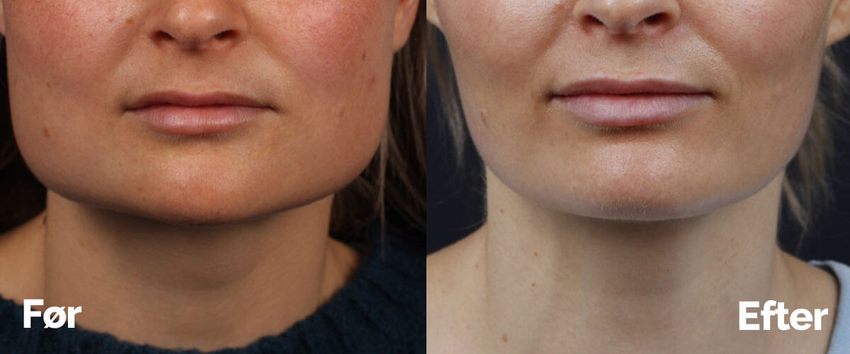Hvad er Botox? - Retouch Clinic