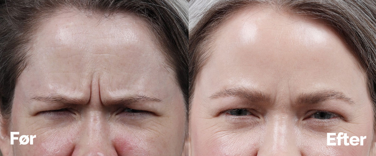 Hvad er Botox? - Retouch Clinic