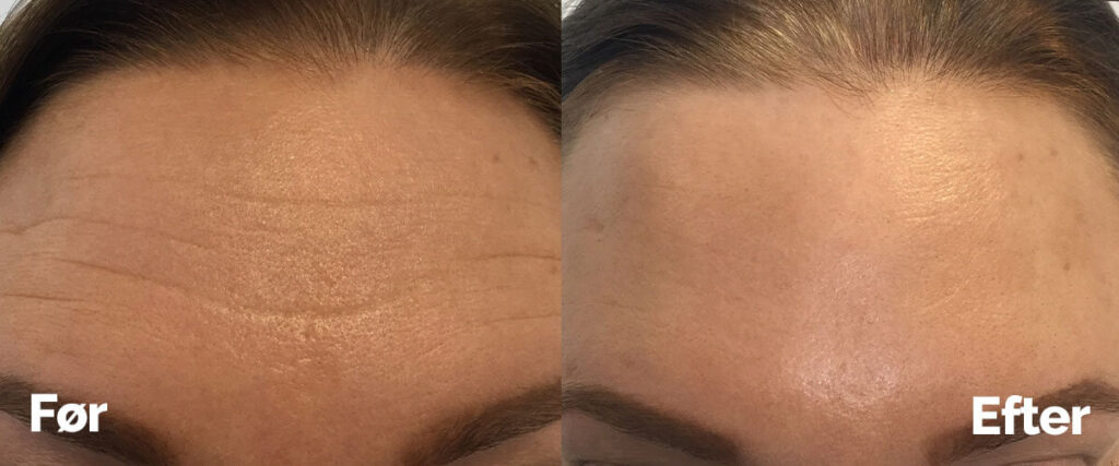 Botox behandling | Effektiv rynkebehandling hos Retouch Clinic